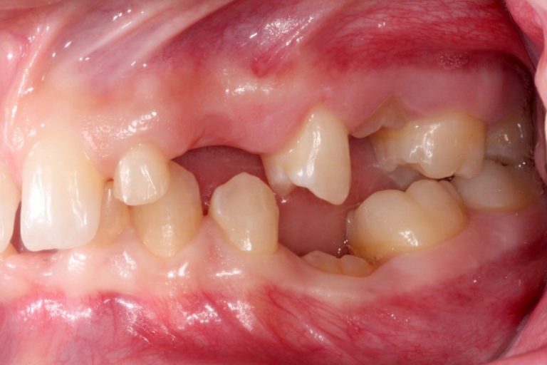 Avulsion de dents incluses – Centre dentaire de la Comédie